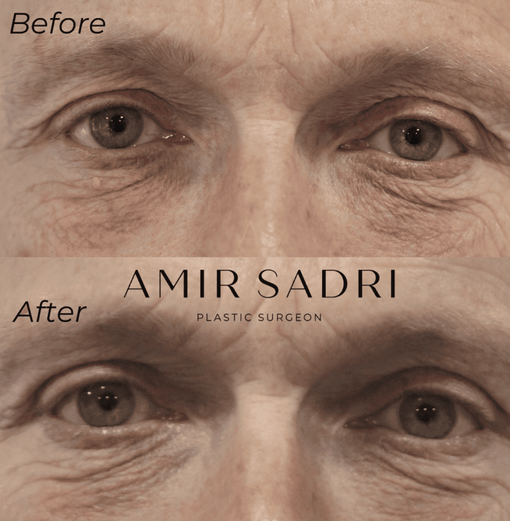 Upper Blepharoplasty | Dr. Amir Sadri
