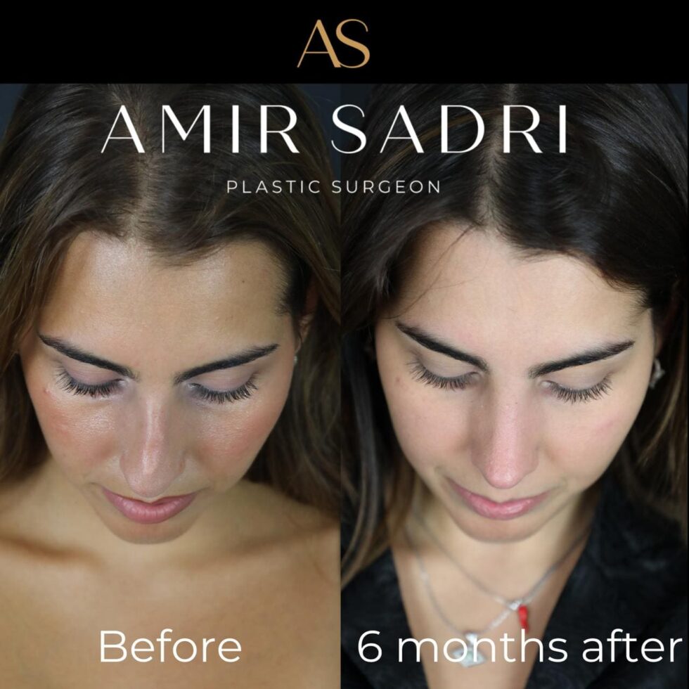 Amir Sadri Gallery | Dr. Amir Sadri | Rhinoplasty London