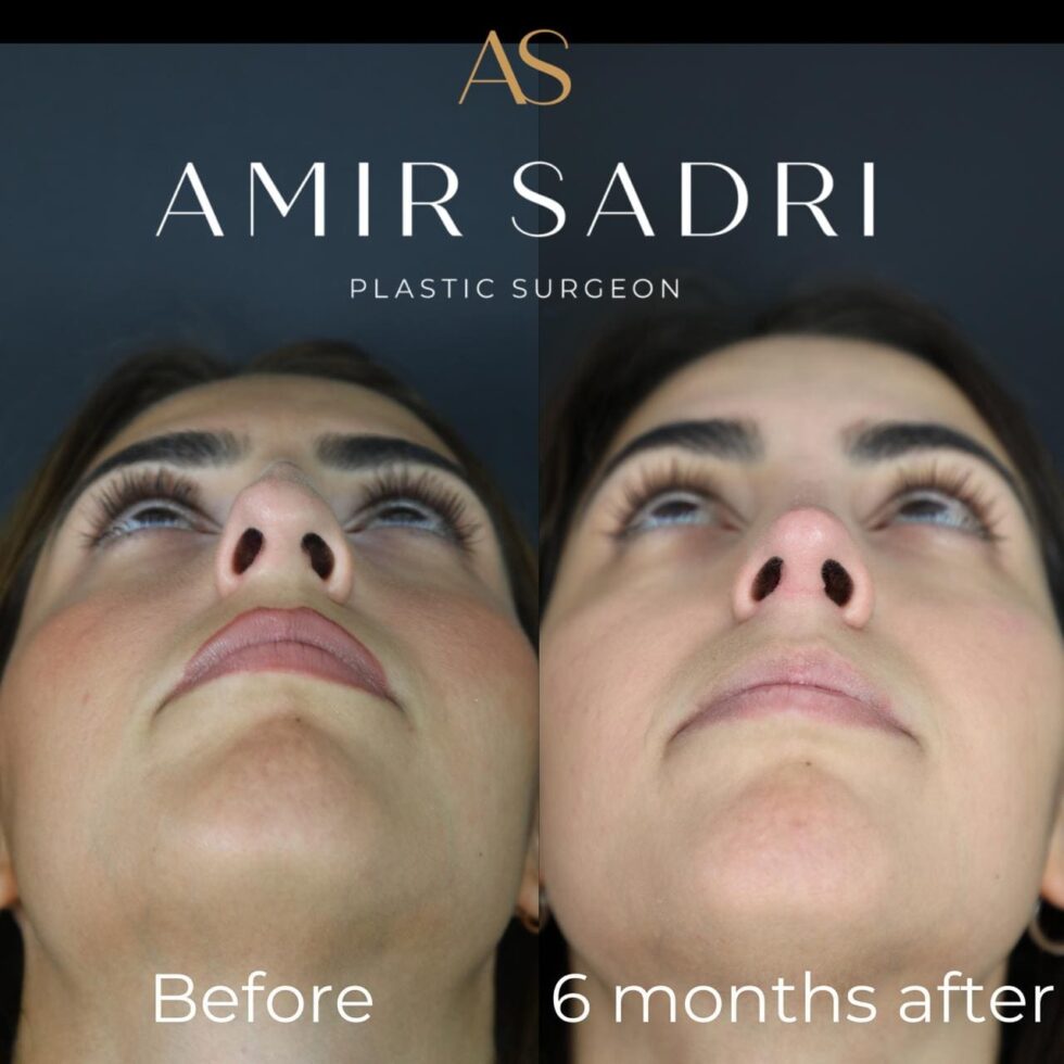 Amir Sadri Gallery | Dr. Amir Sadri | Rhinoplasty London