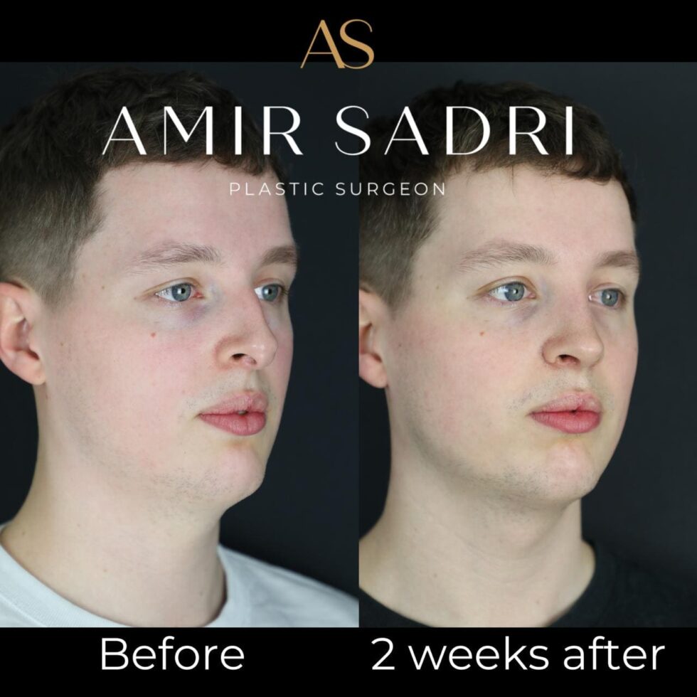 Amir Sadri Gallery | Dr. Amir Sadri | Rhinoplasty London